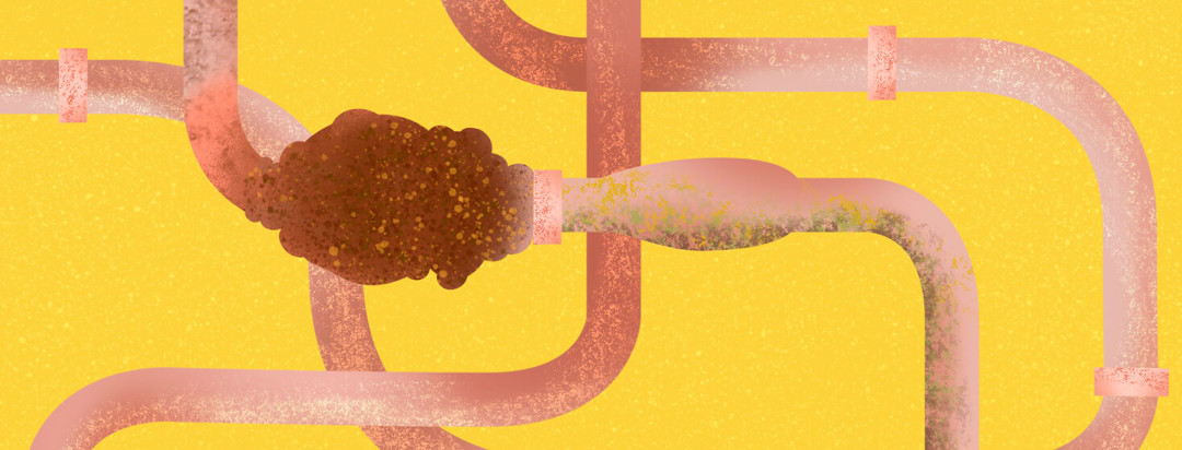 Distal Intestinal Obstructive Syndrome (DIOS) With Cystic Fibrosis