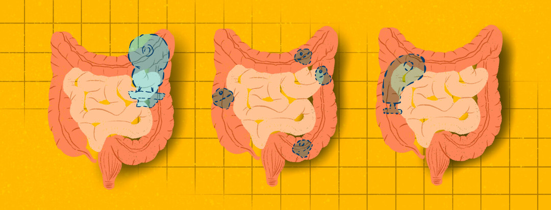 What Are The Types Of Ostomies For People With Cystic Fibrosis?